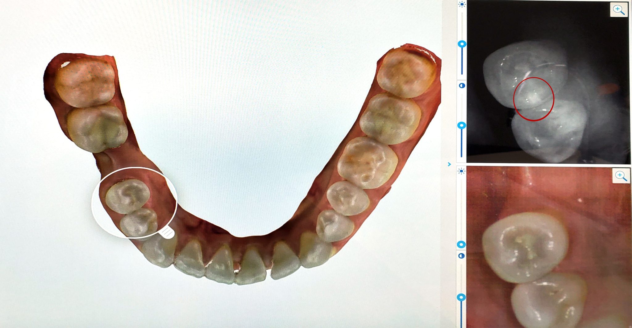 NIRI Cavity Detection | Dentist in Riverside, CA